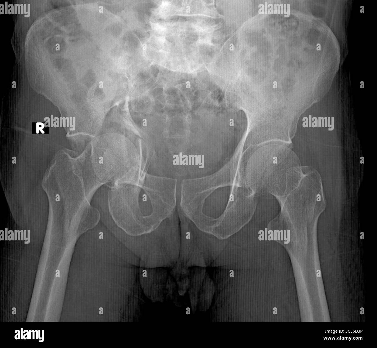 X-ray of the pelvis of a 60 year old male with a right hip dislocation ...