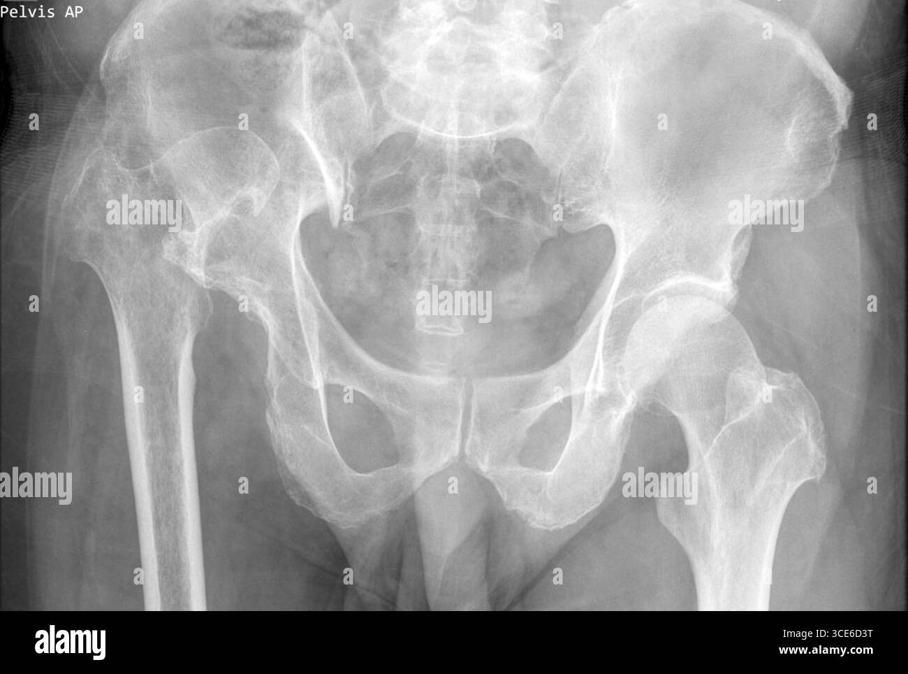 Hip socket is shallow hi-res stock photography and images - Alamy