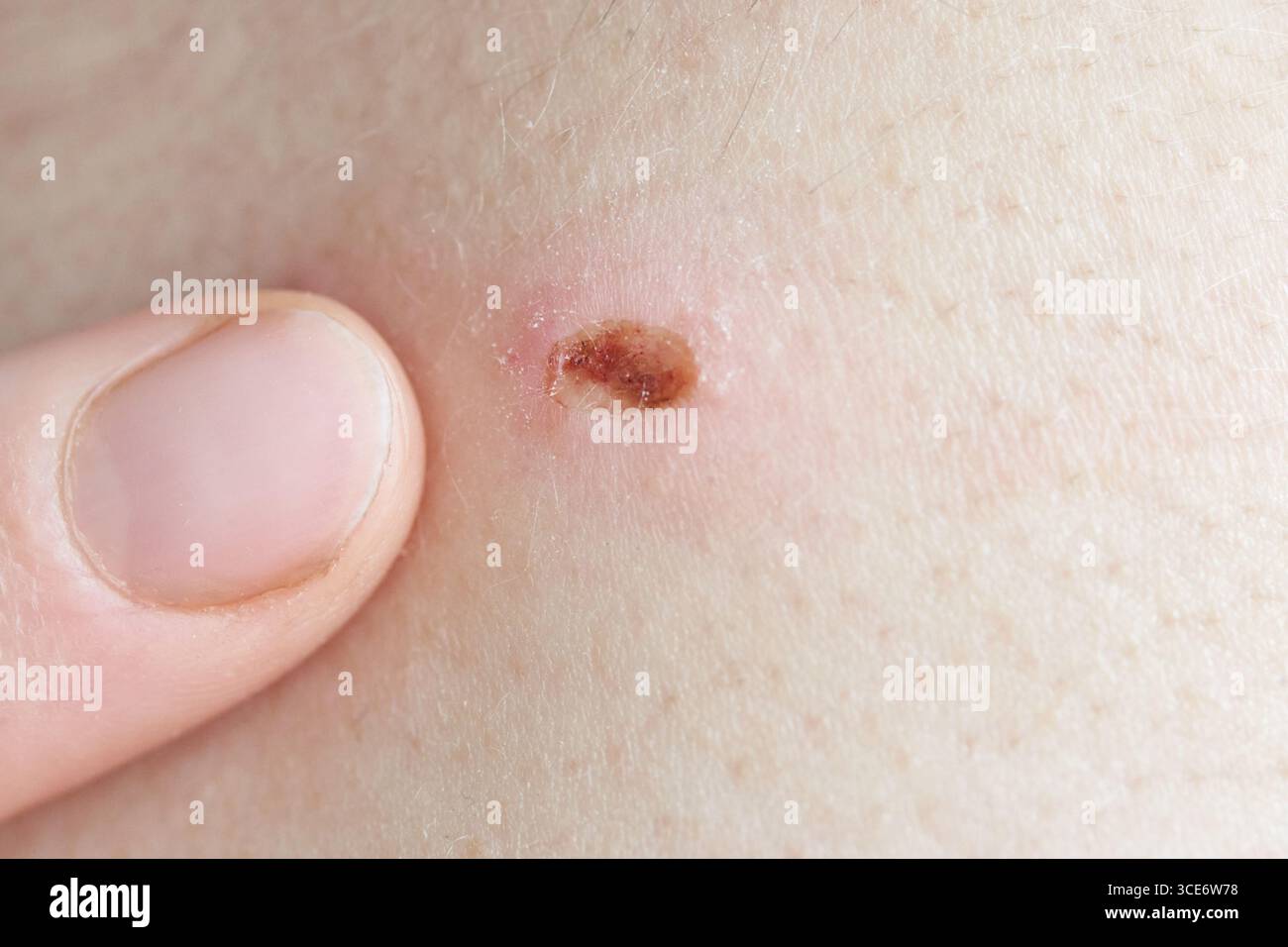Close-up of a healing skin wound with scab formation Stock Photo - Alamy