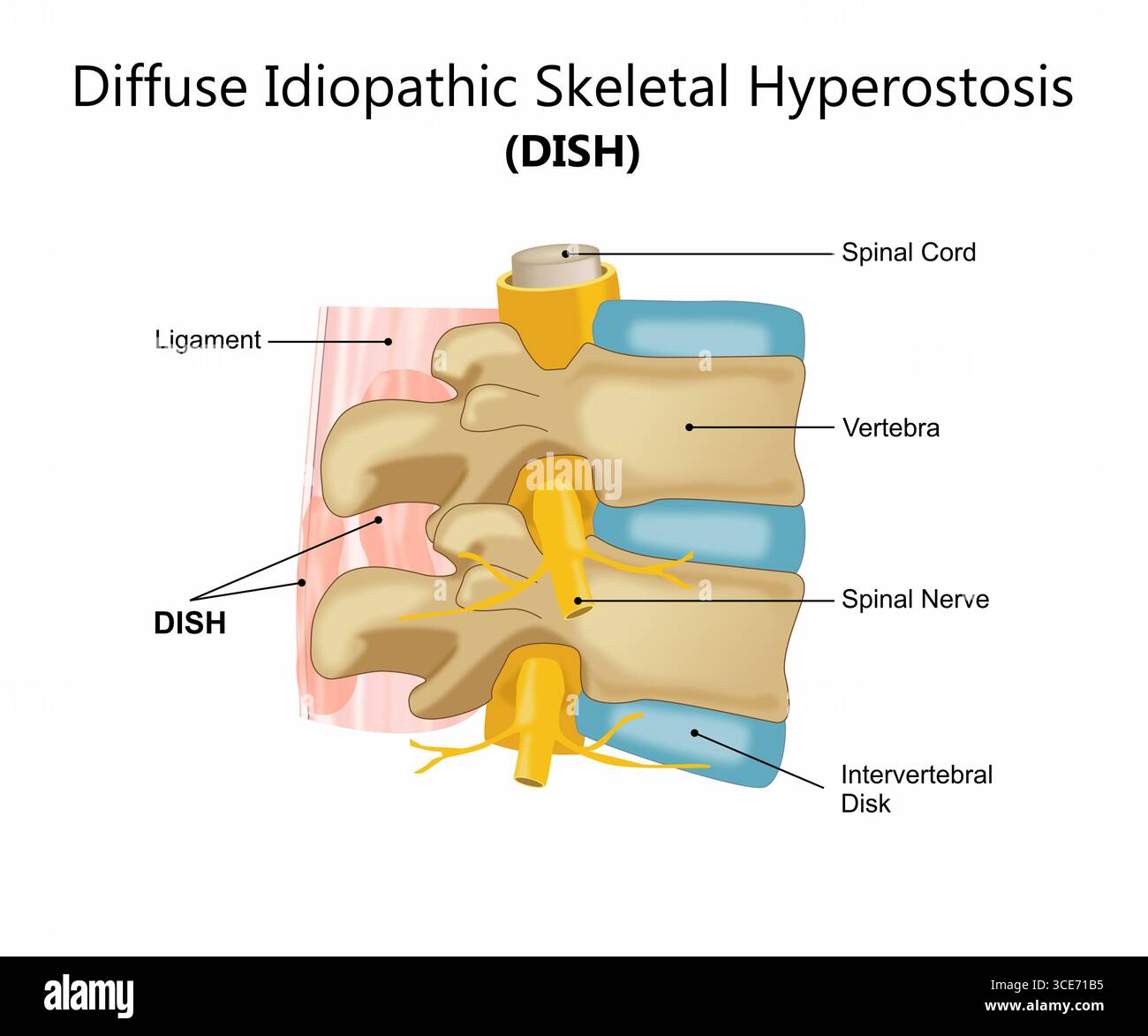 Diffuse idiopathic skeletal hi-res stock photography and images - Alamy