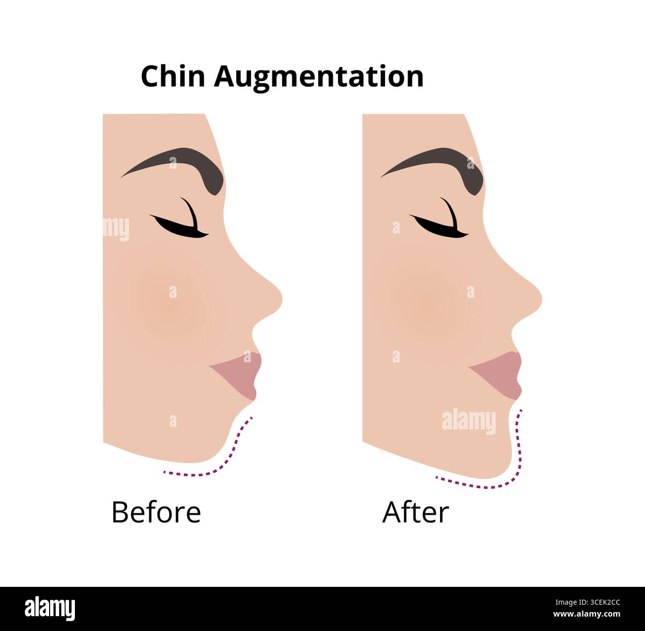 Chin augmentation surgery reshapes and enhances projection of the chin ...