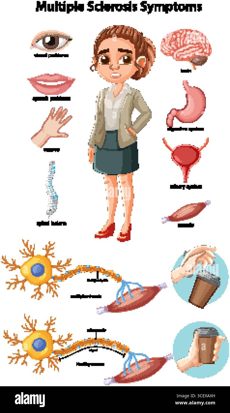 Diagram showing symptoms multiple sclerosis Cut Out Stock Images ...