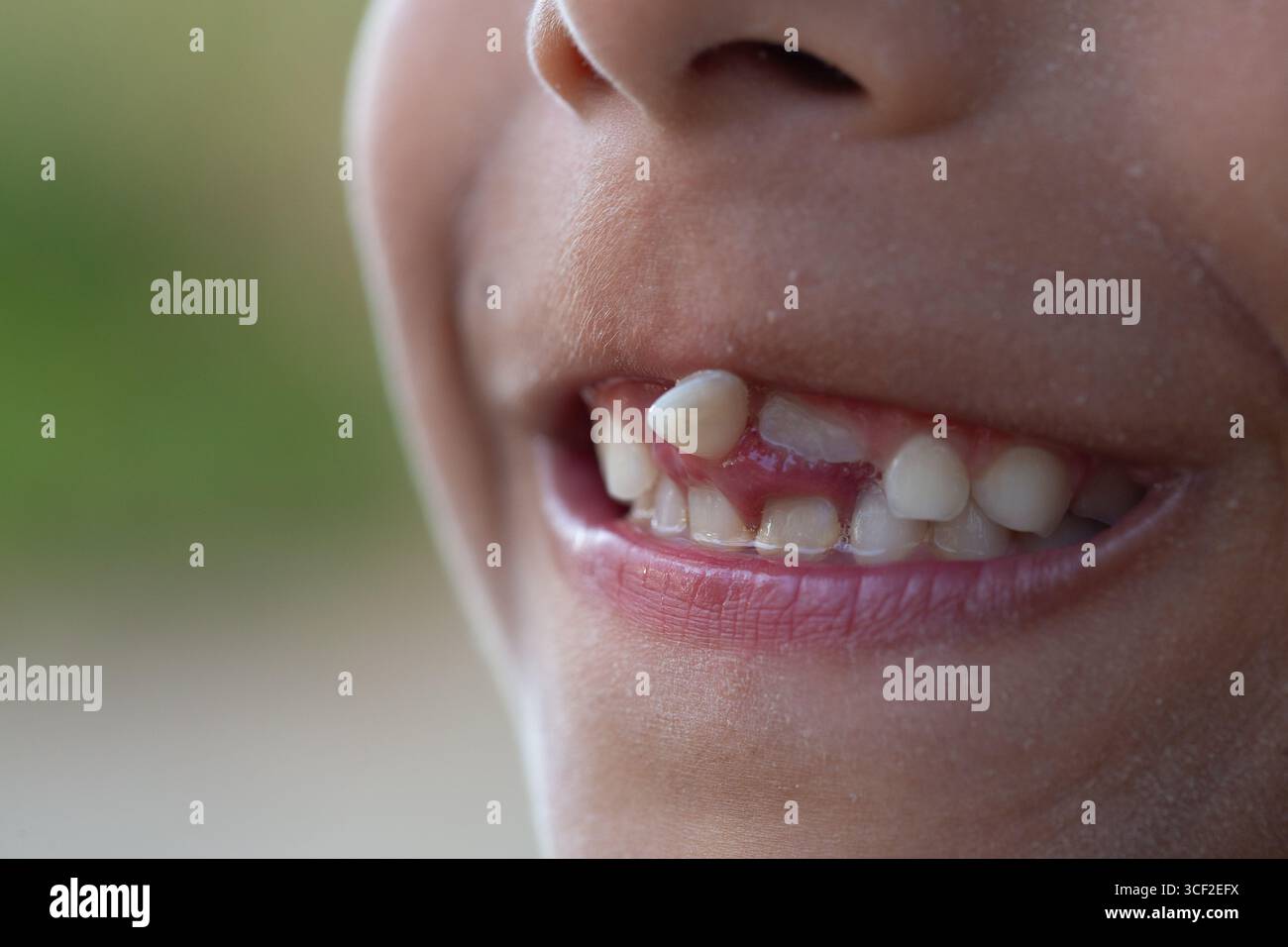 Close-up of a child's mouth showing a wobbly milk tooth, indicating the ...