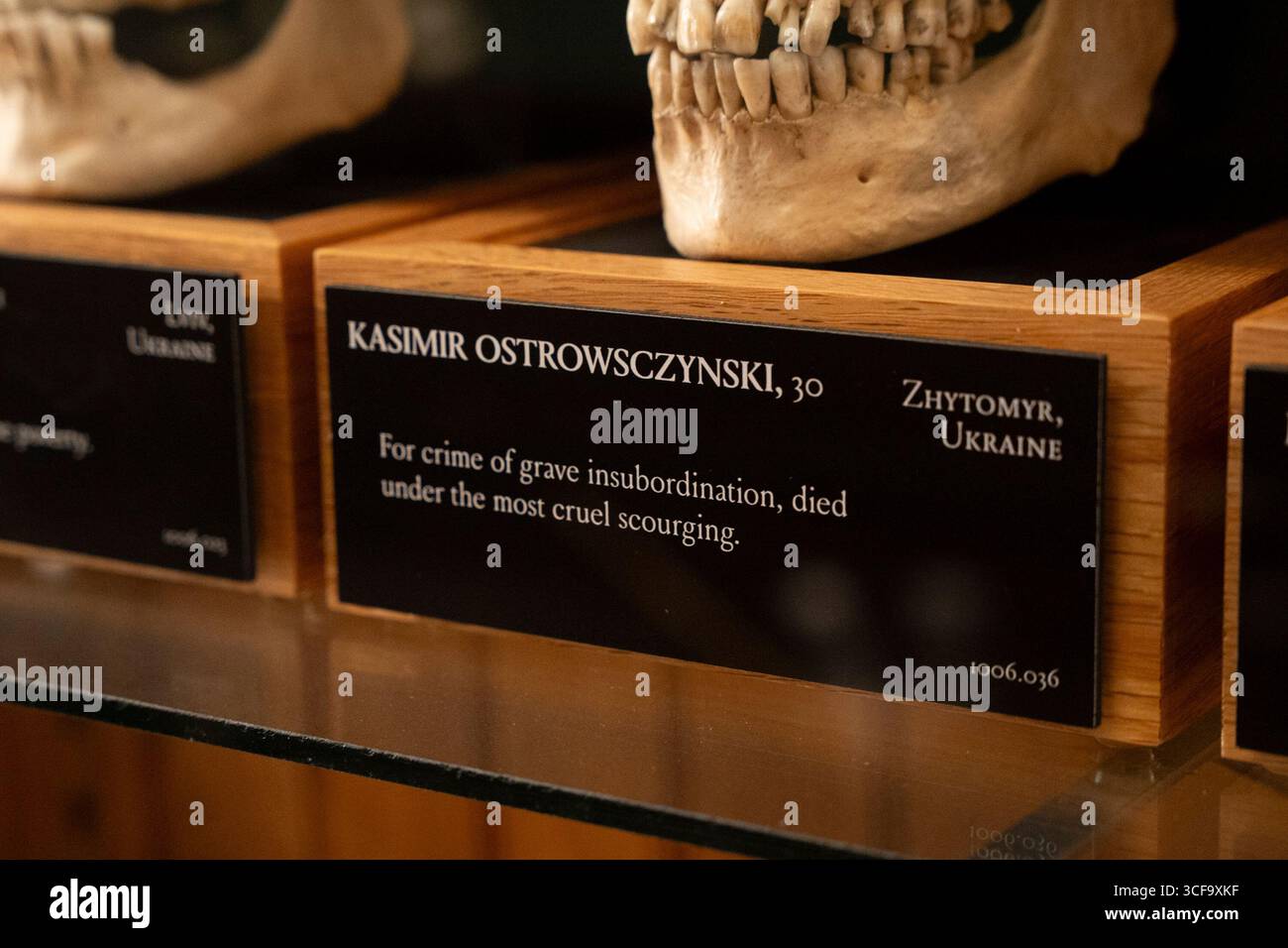 The skull of Kasimir Ostrowsczynski displayed at the Mütter Museum on ...