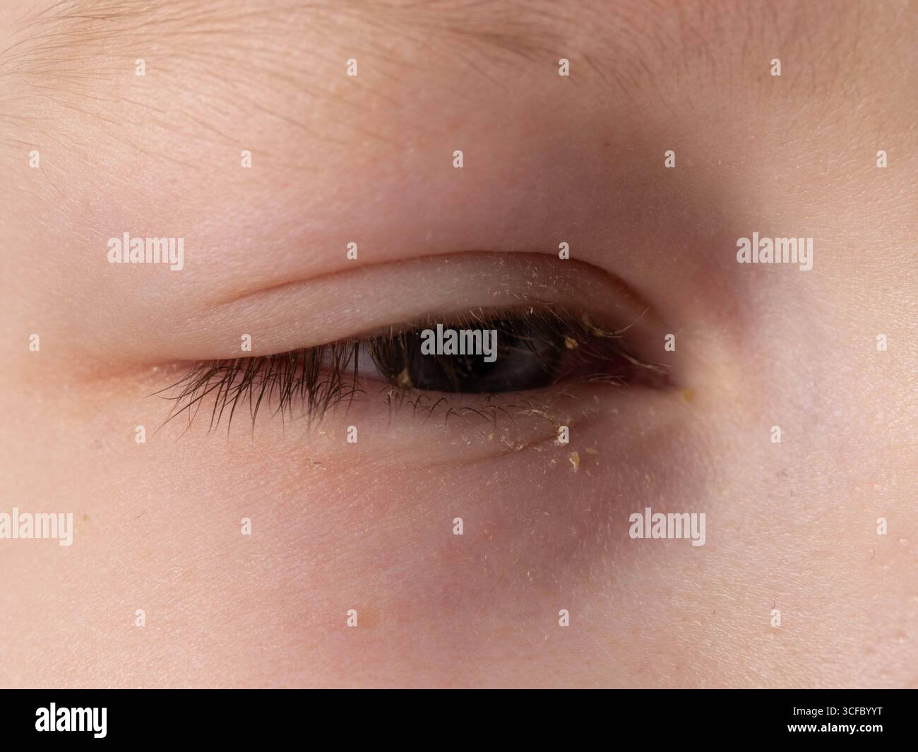 Painful red eye of a girl during a viral cold. Inflammation ...
