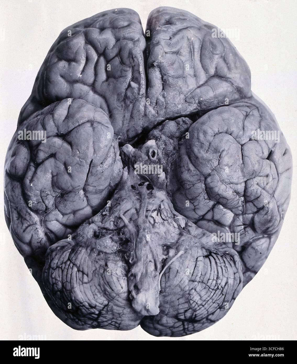 Friern Hospital, London: a brain, seen from beneath, 1890/1910. Friern ...