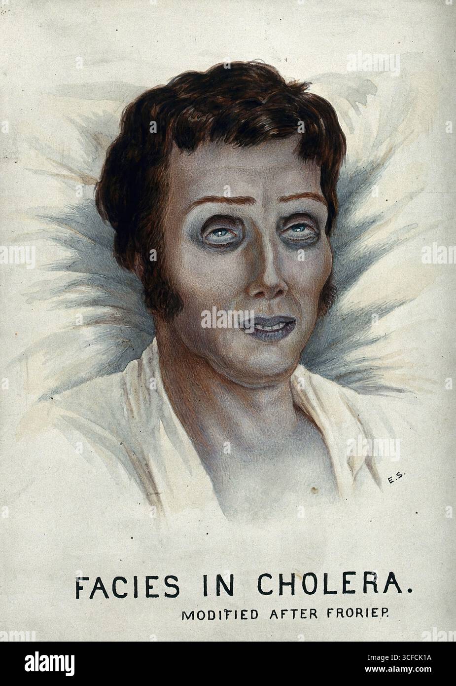 A cholera victim with a typical facial appearance, 1920-1950 Stock ...