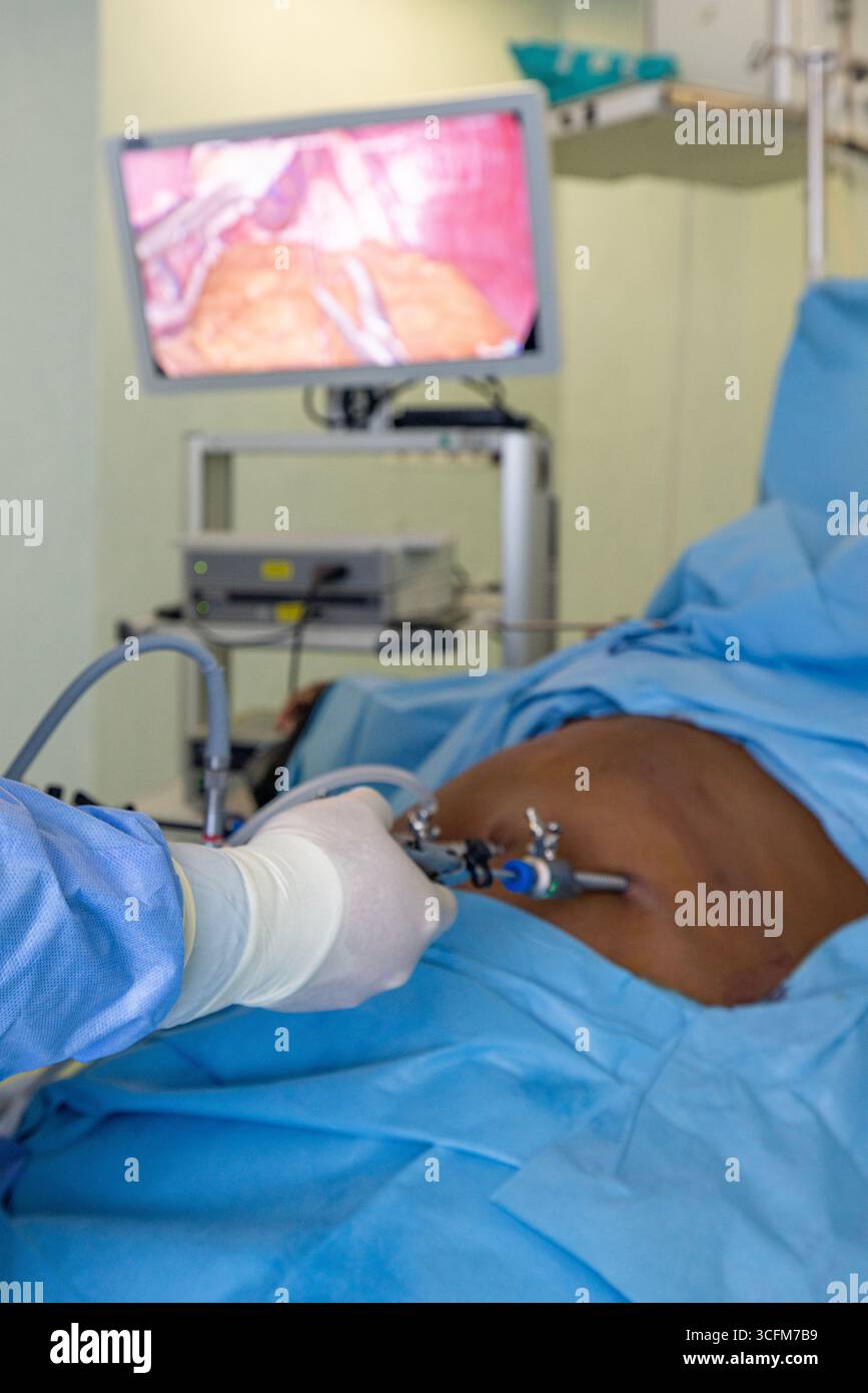 Laparoscopic Surgery, gastric sleeve, gastric bypass, hernia repair ...