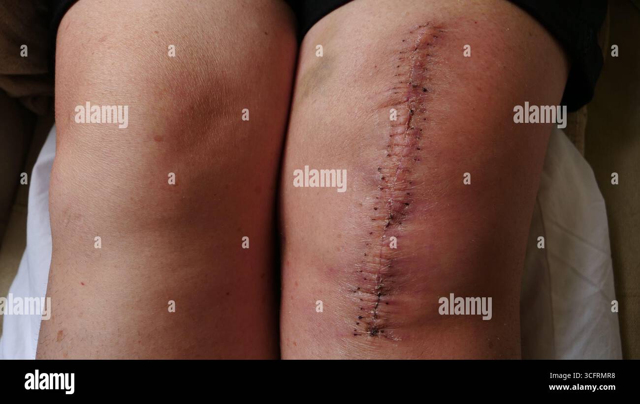 Total knee replacement hi-res stock photography and images - Alamy