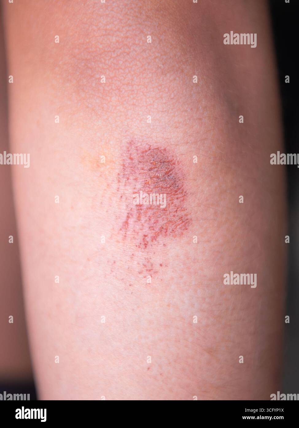 A person has a red mark on their arm. The mark is small and red, and it ...