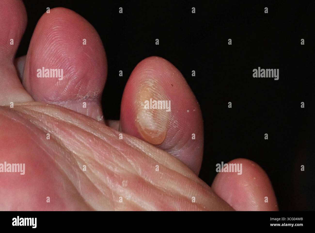 Hautschichten hi-res stock photography and images - Alamy