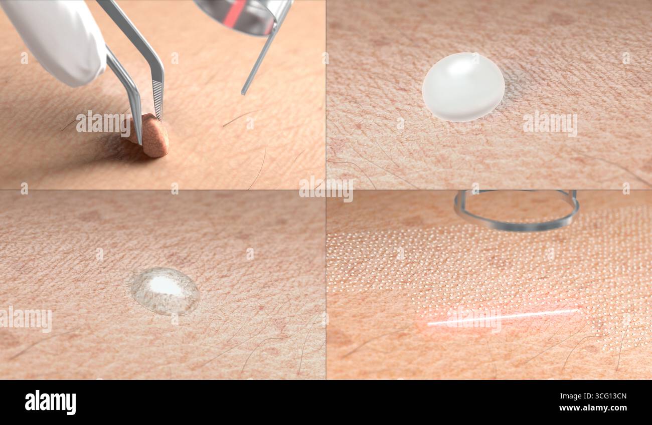 Skin surface case treatment hi-res stock photography and images - Alamy