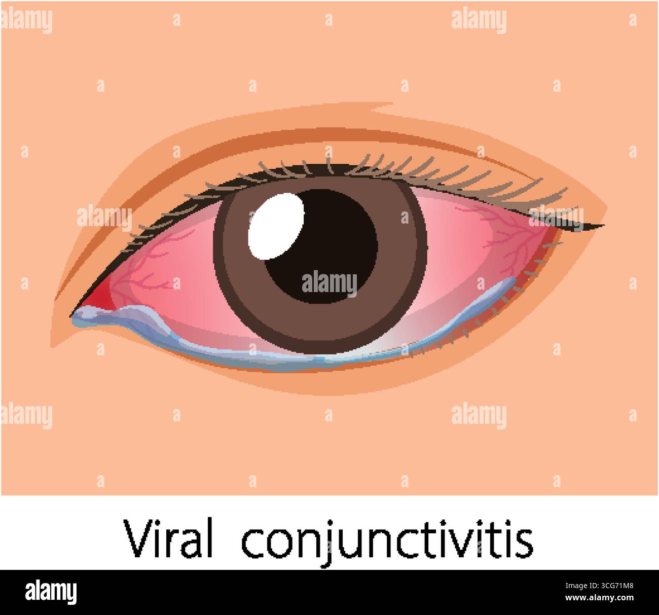 Vector illustration of a red, irritated human eye with watery discharge ...