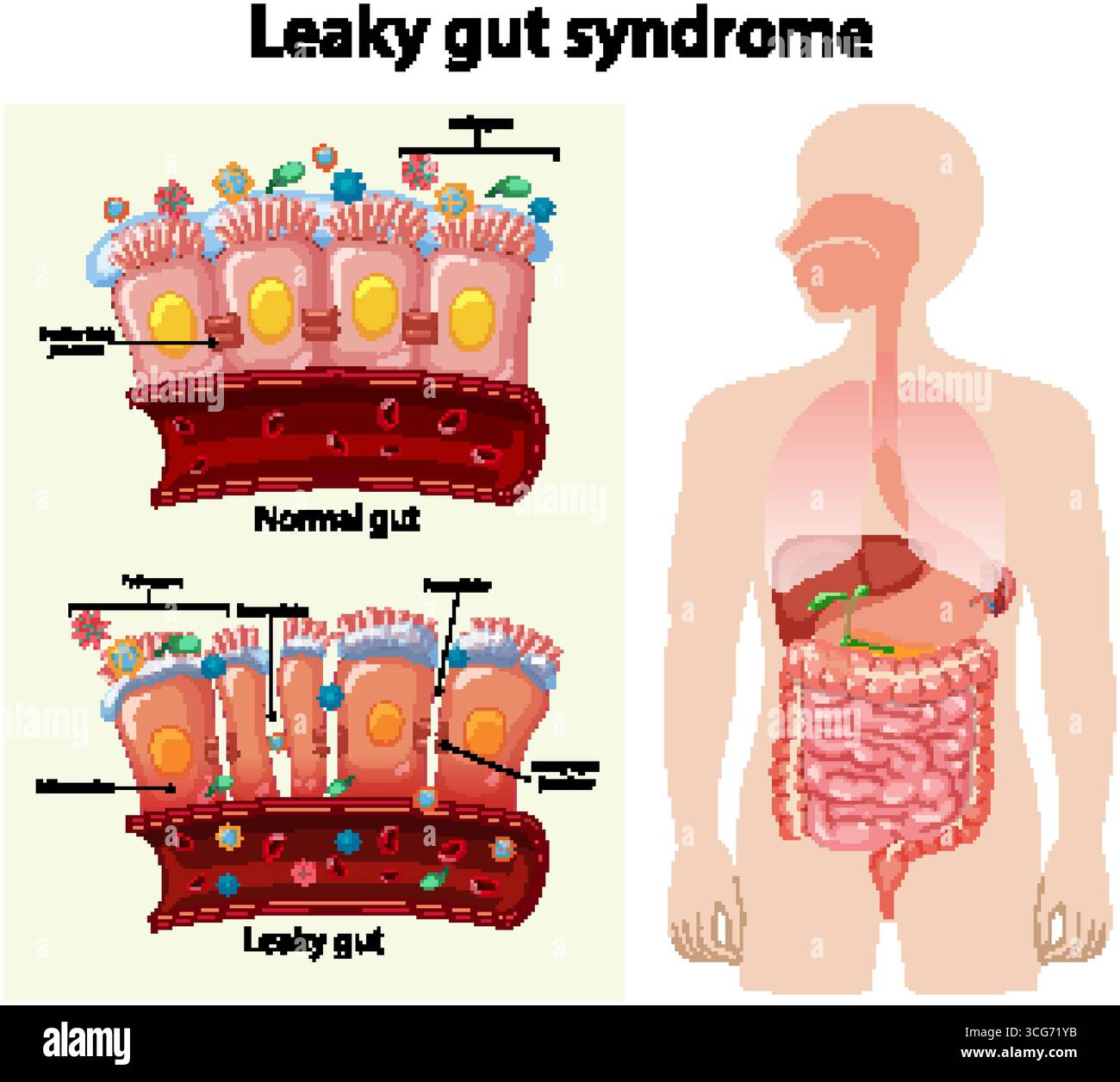 Flat vector diagram comparing healthy and leaky gut, showing ...
