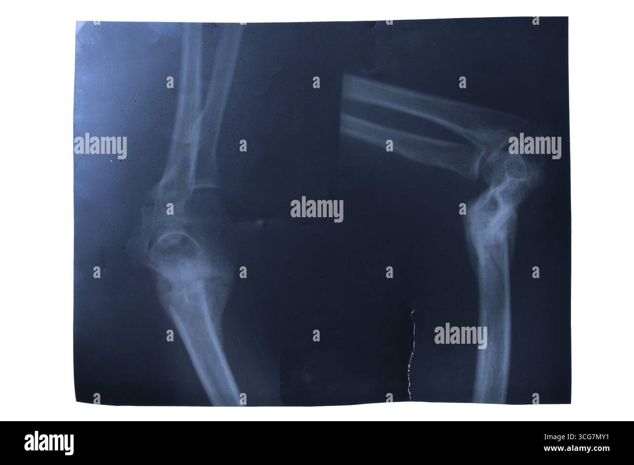 X-ray of forearm isolated on white background Stock Photo - Alamy