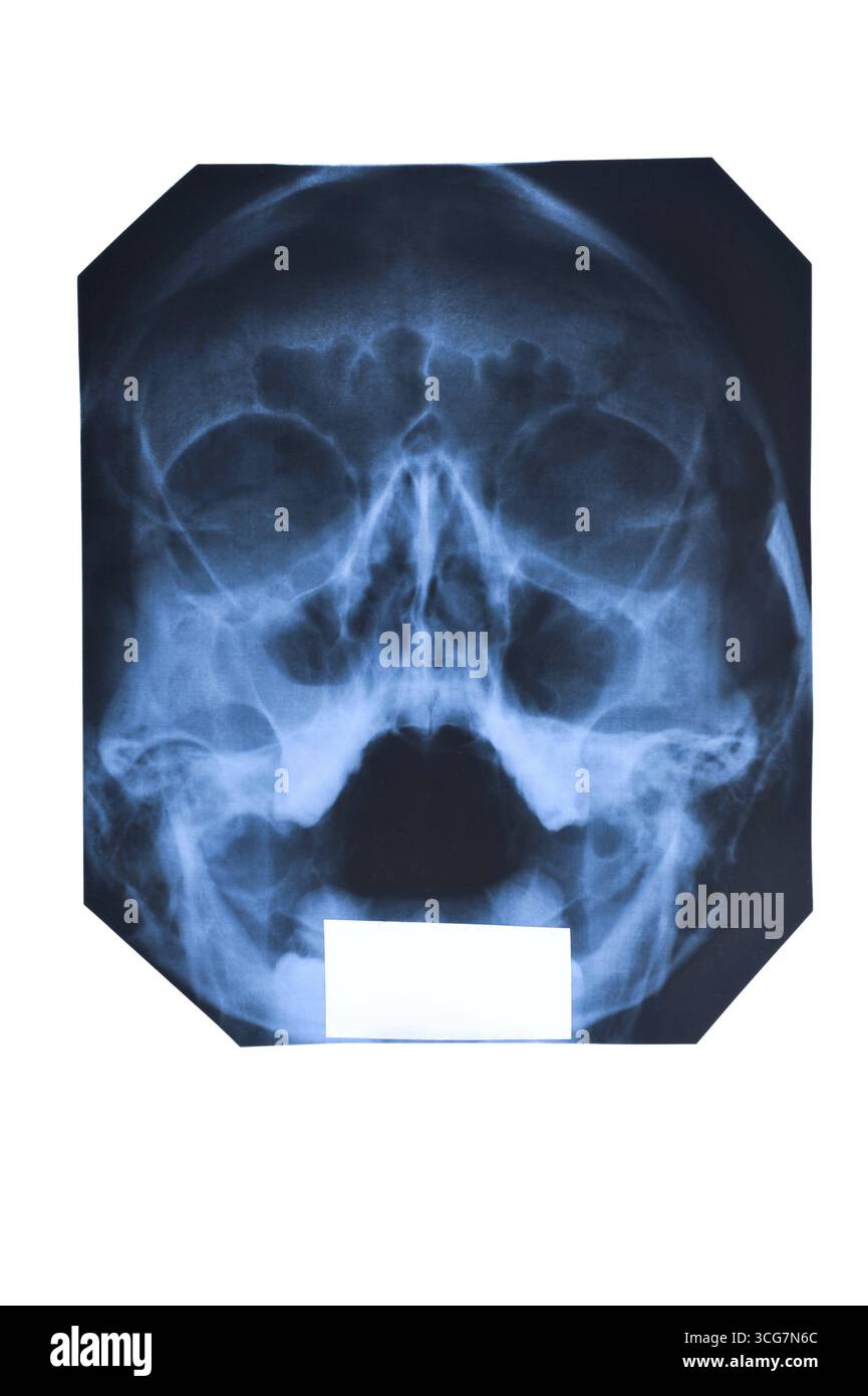 X-ray of face and maxillary sinuses isolated on white Stock Photo - Alamy
