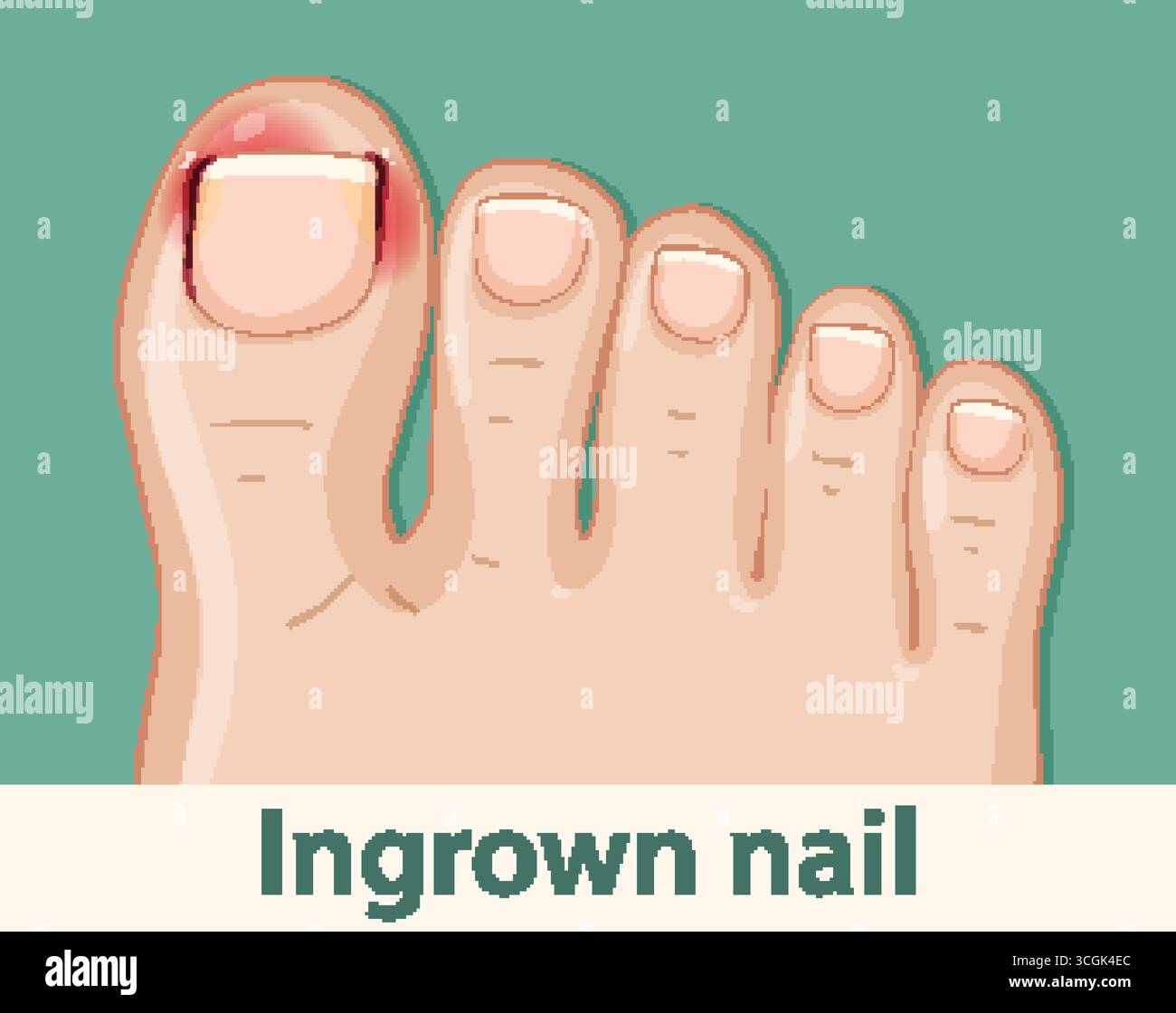 Vector illustration of inflamed ingrown toenail on big toe, labeled ...