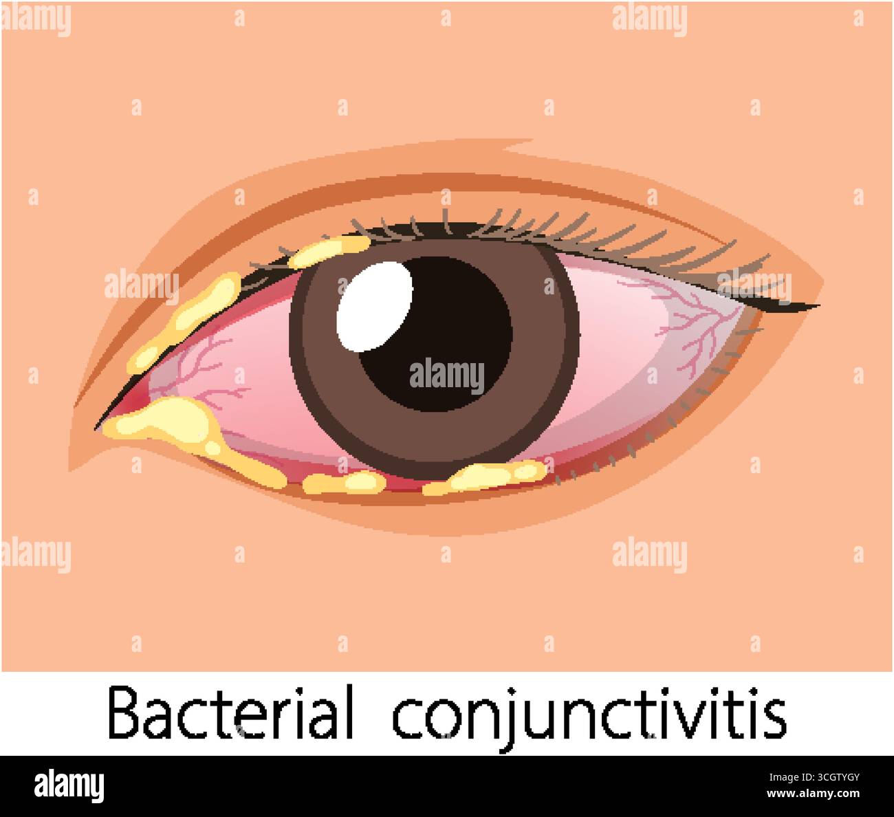 Vector illustration of human eye with bacterial conjunctivitis, showing ...