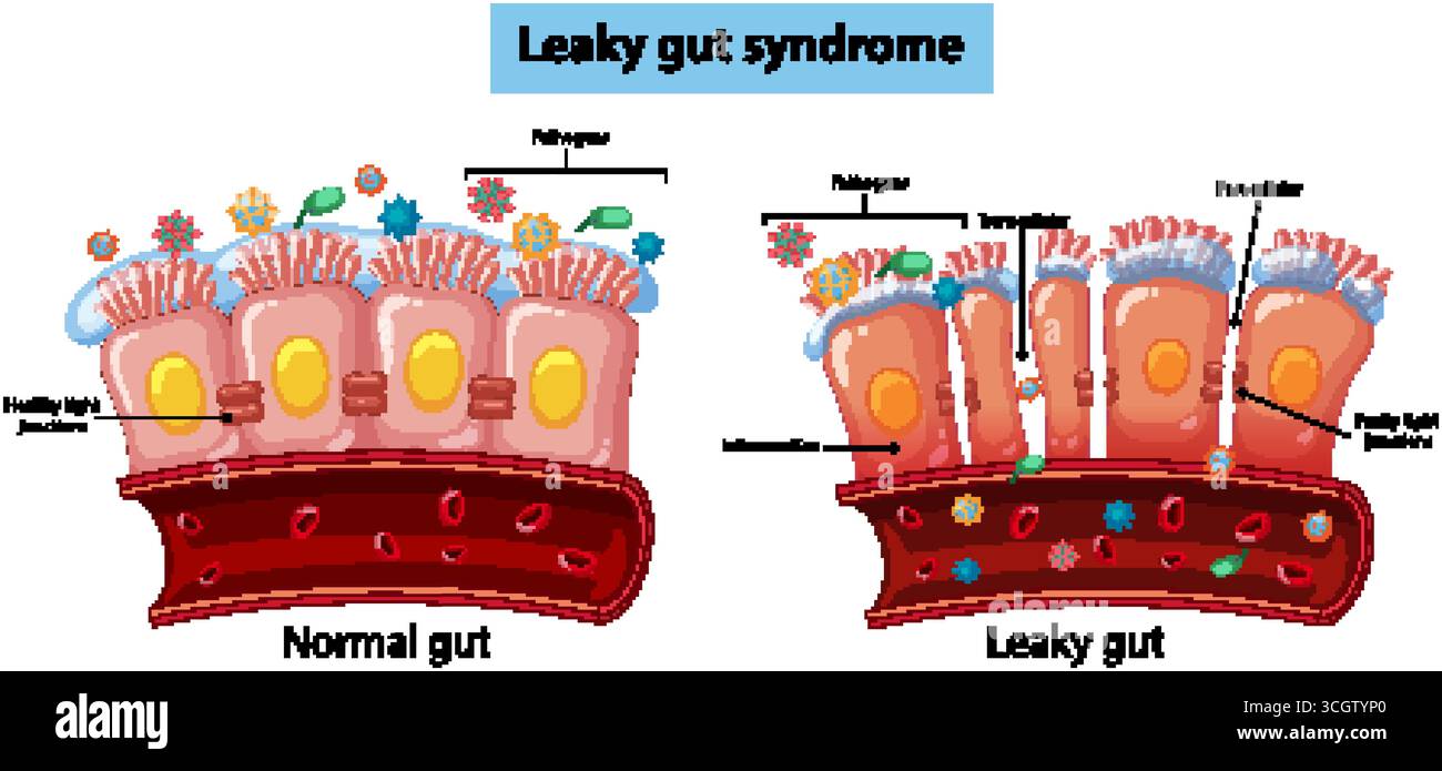 Flat vector illustration comparing healthy and leaky gut lining ...