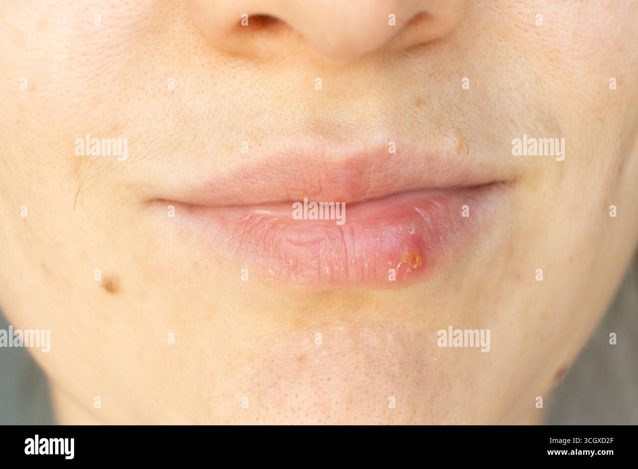 Macro Closeup of Herpes on Human Lip Stock Photo - Alamy