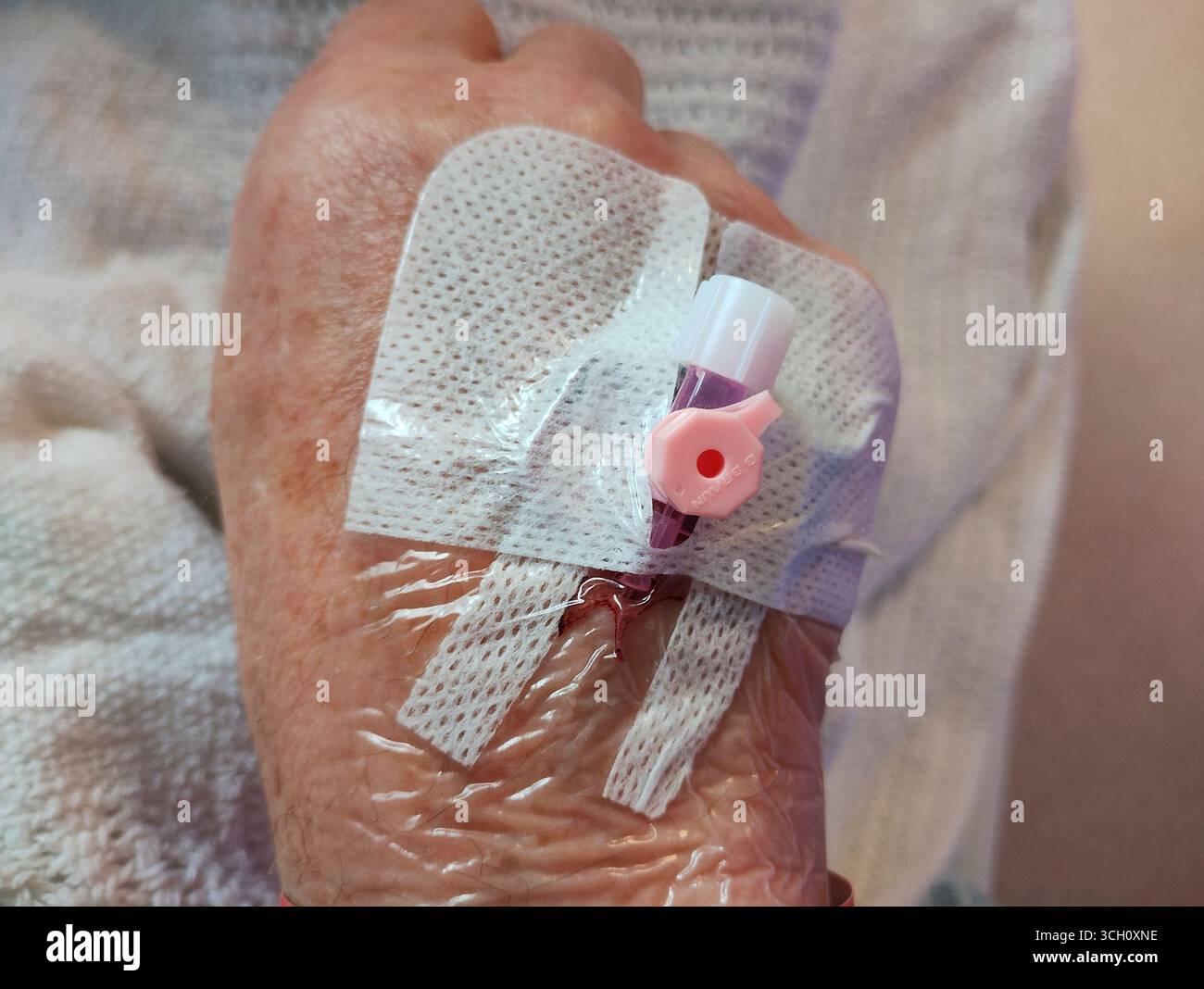 Canula in patients hand hi-res stock photography and images - Alamy