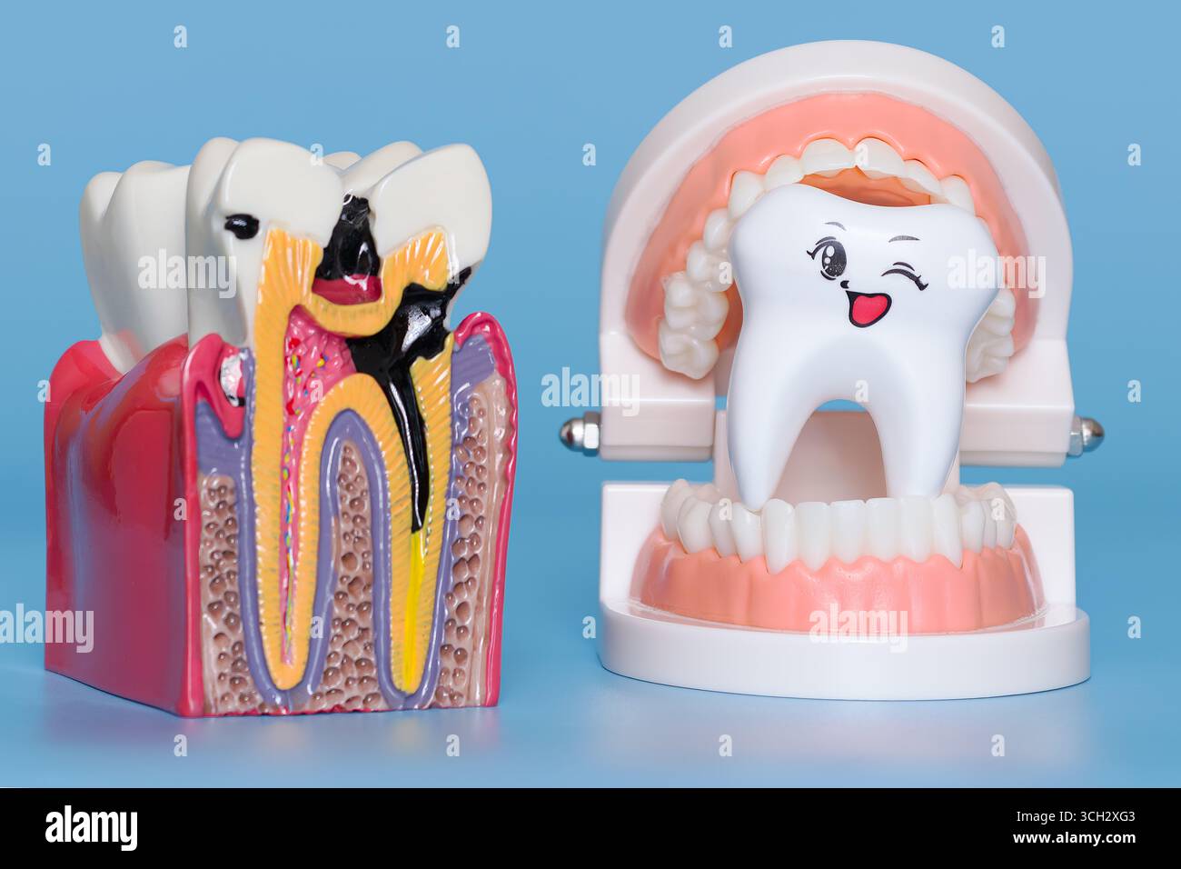 Tooth decay anatomy model and winking tooth Stock Photo - Alamy