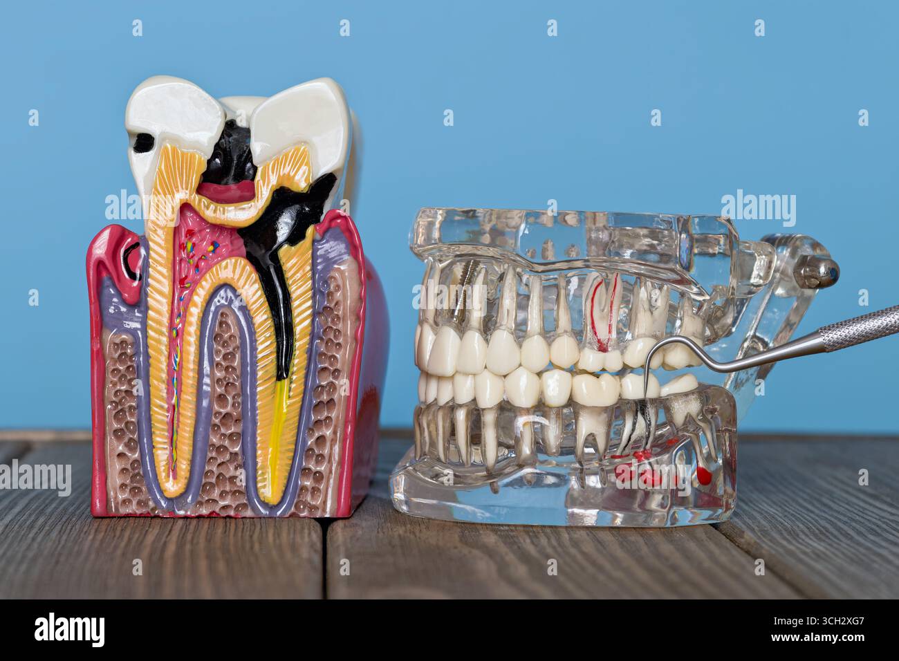 Close-up of anatomical tooth decay model next to transparent jaw model ...