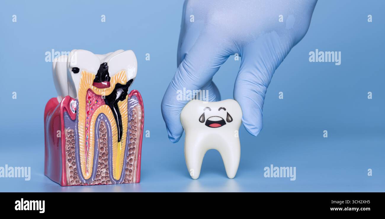 Dental model showing severe tooth decay alongside a cartoon tooth with ...