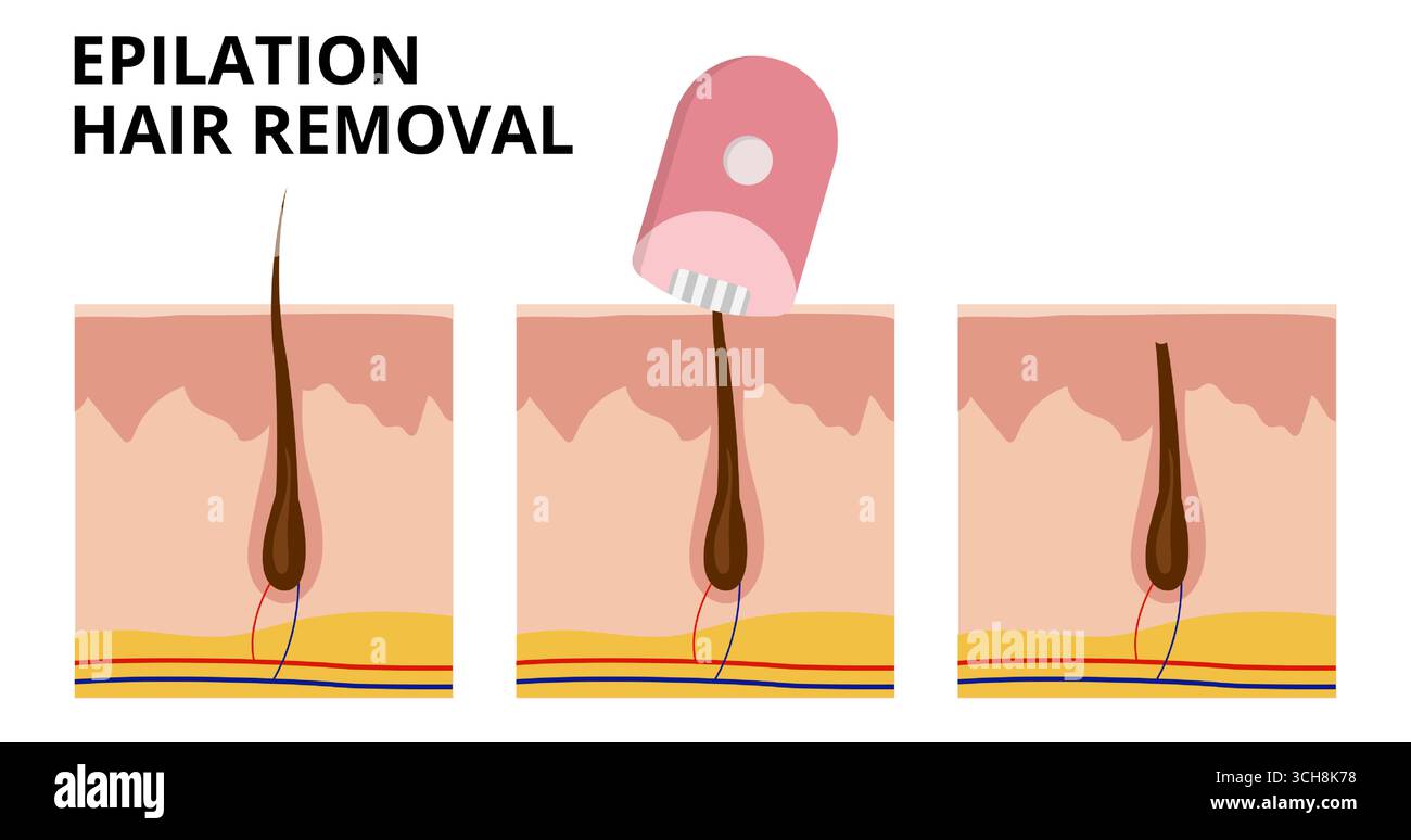 Epilating hair from beneath the skin surface, medical diagram ...