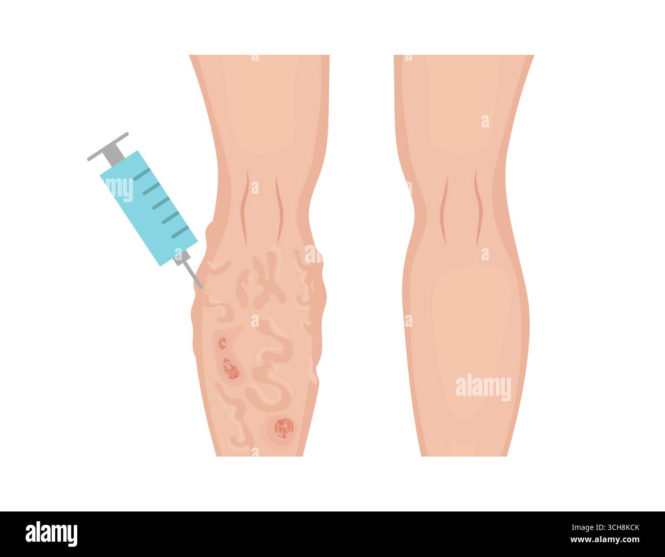 Sclerotherapy treatment injecting medicine into varicose veins on ...