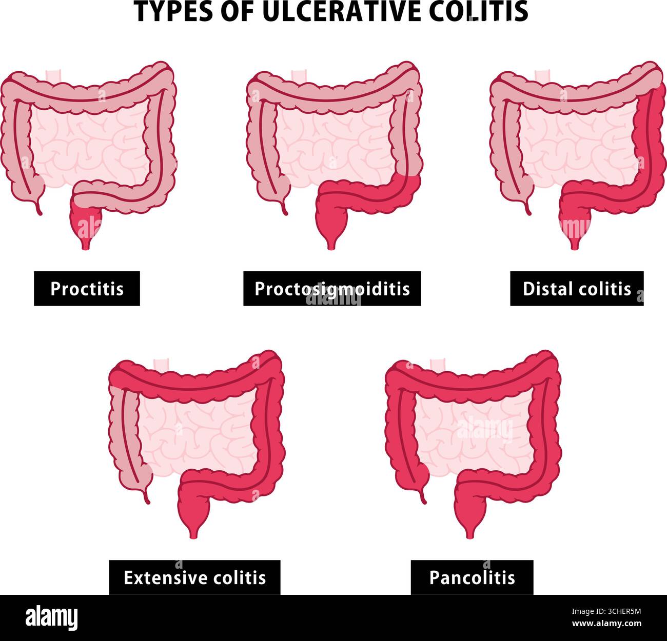 Types of ulcerative colitis. Vector illustration Stock Vector Image ...