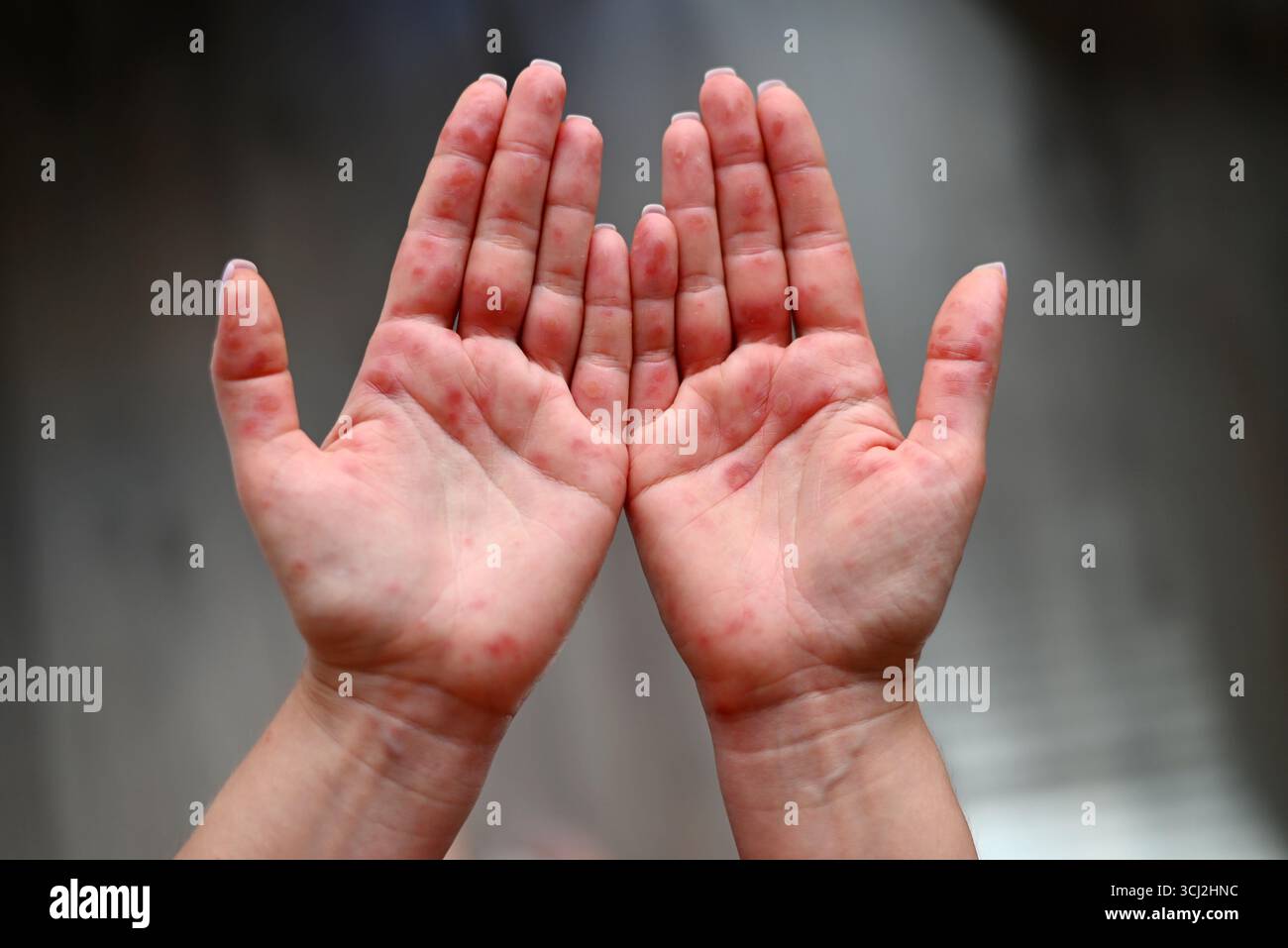 Close-up of human palms with red rash caused by Coxsackievirus, showing ...