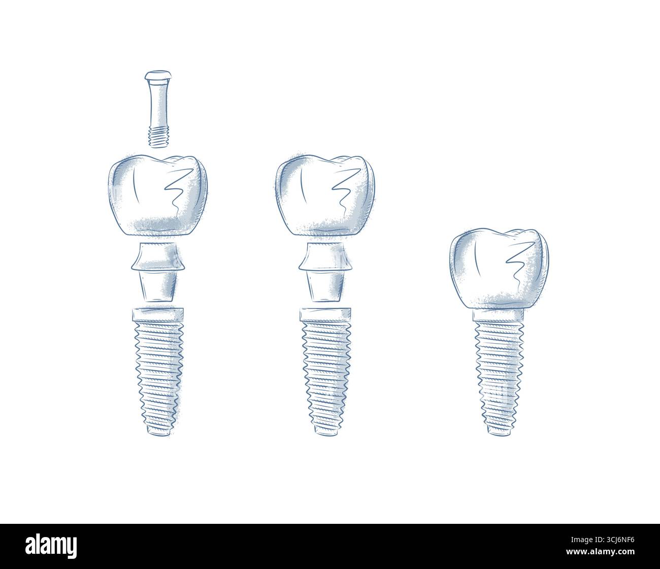 Tooth implant parts illustration drawing in graphic style with blue on ...