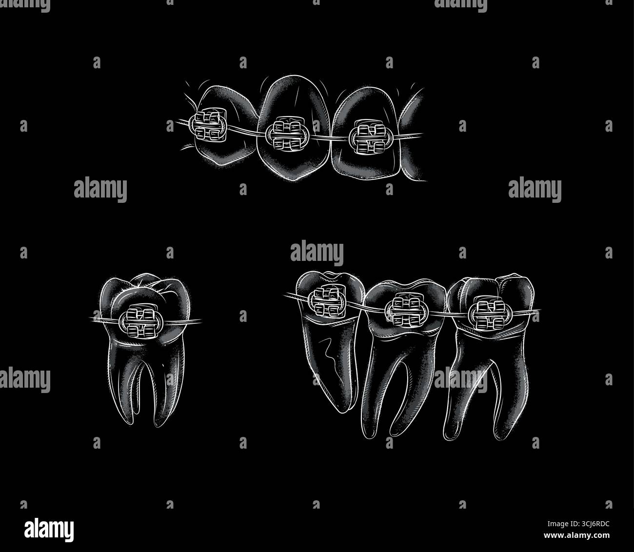 Teeth with braces set illustration drawing in graphic style with white ...