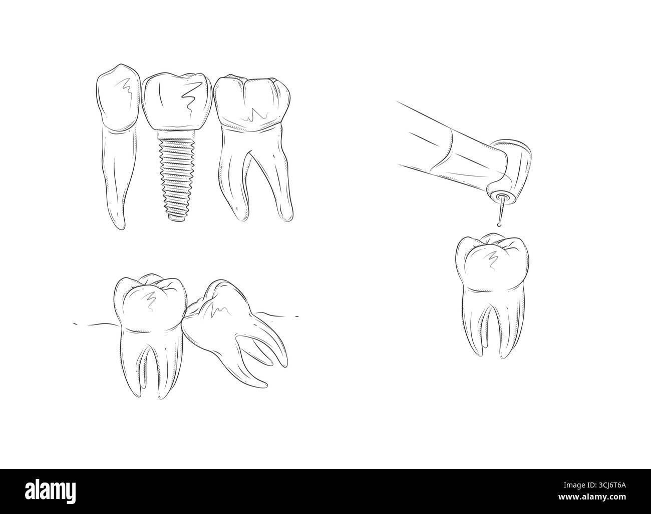 Drill the tooth with dental machine, implant, remove sick teeth ...