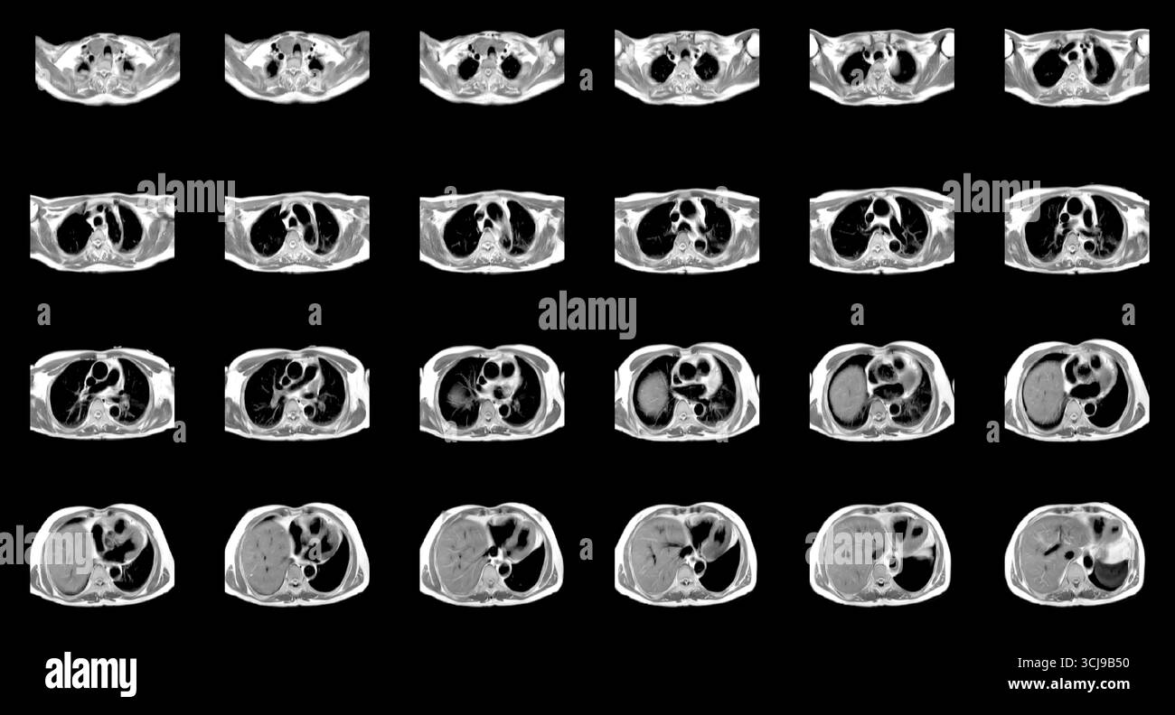 MRI heart stress test revealing detailed cardiac function under ...