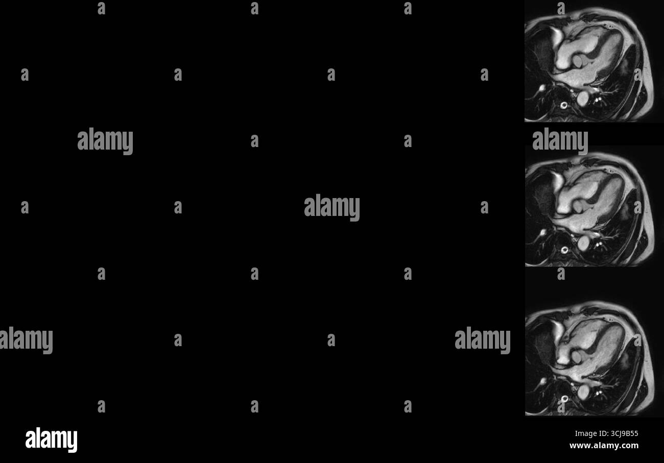 MRI heart stress test revealing detailed cardiac function under ...