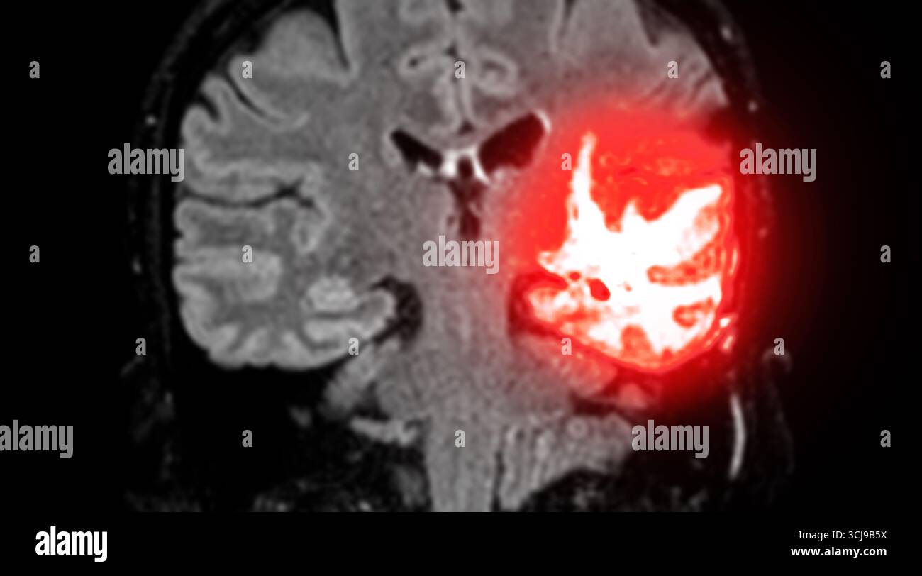 MRI scan reveals a lesion in the left hemisphere of the brain ...
