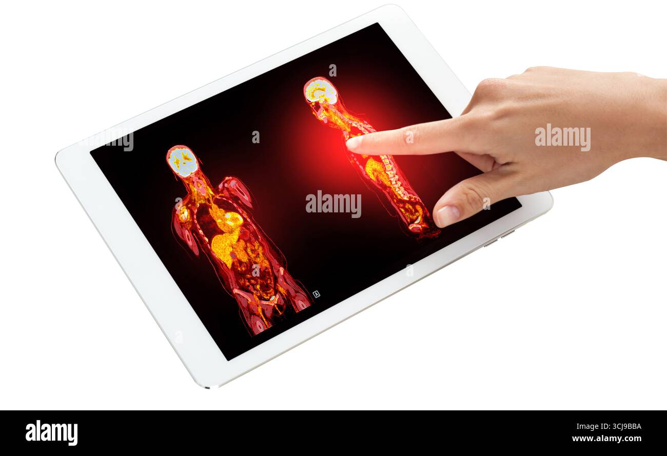 PET CT Scan fusion image displayed on tablet with hand pointing ...