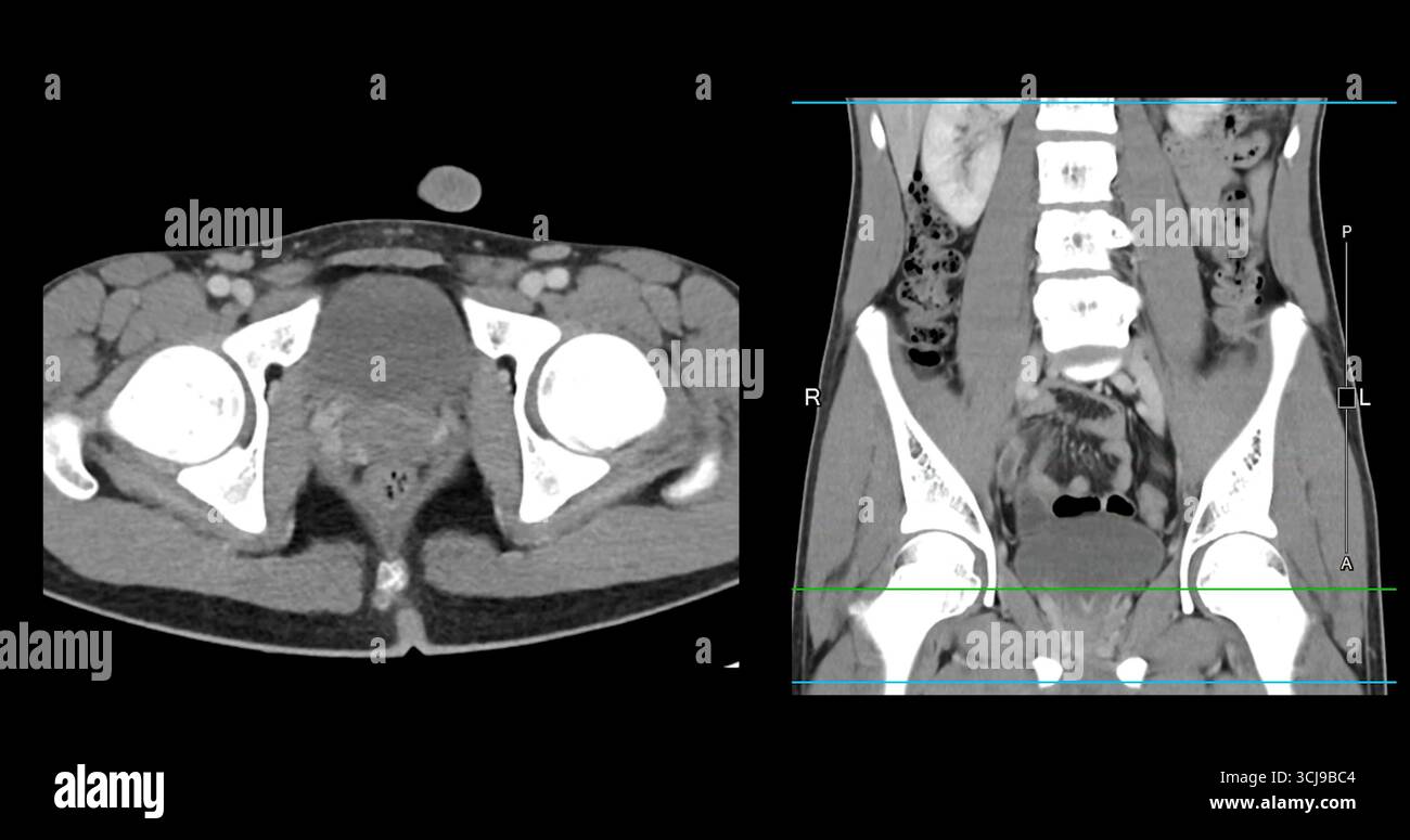 High-resolution CT scan Lower abdomen showing a normal lower abdomen ...