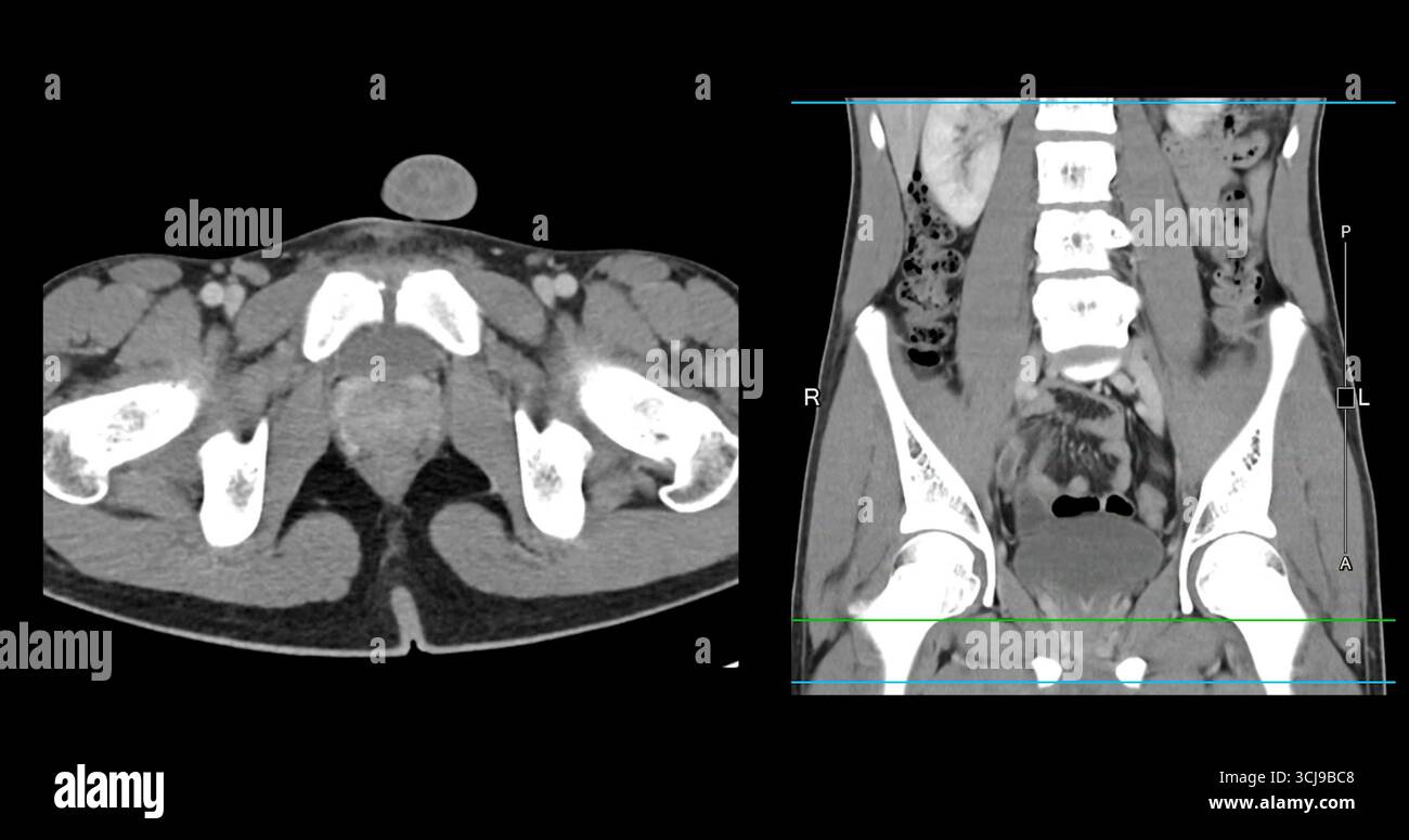 High-resolution CT scan Lower abdomen showing a normal lower abdomen ...