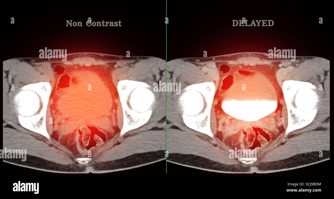 High-resolution CT scan Lower abdomen showing a normal lower abdomen ...