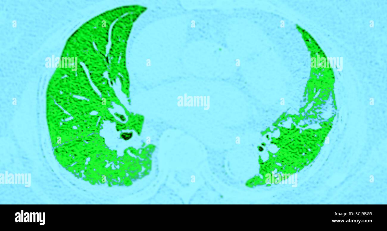 The Vivid CT Chest axial view reveals normal lung, heart, and ...