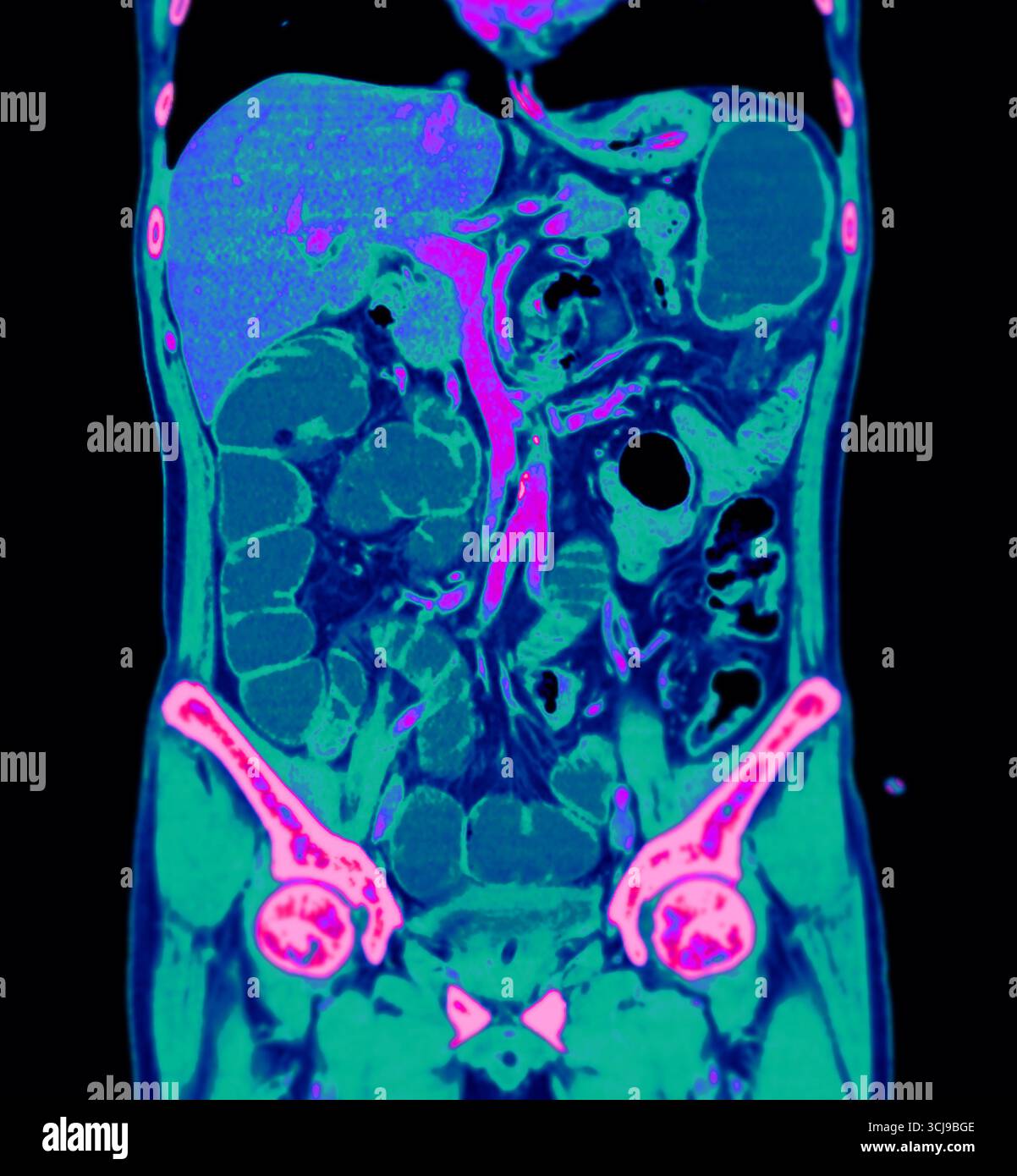 High-resolution abdominal CT image highlighting vascular and organ anatomy with intense color ...