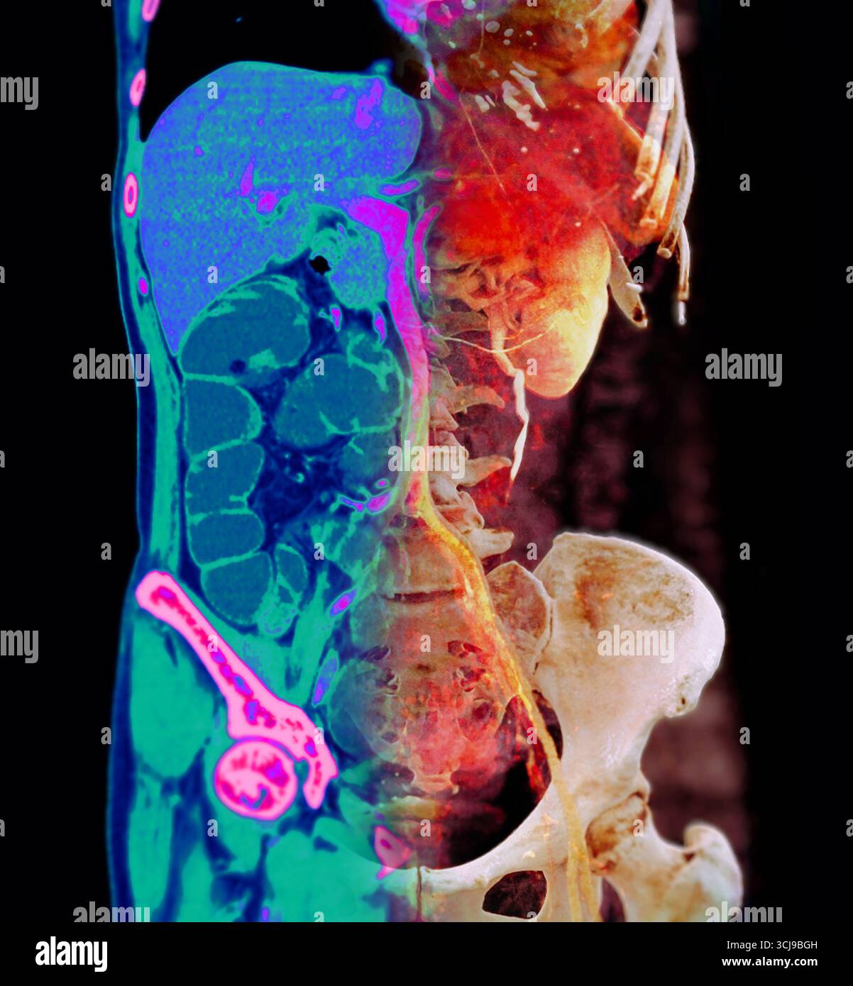 Multiplanar CT image reveals abdominal and spinal structures in a ...