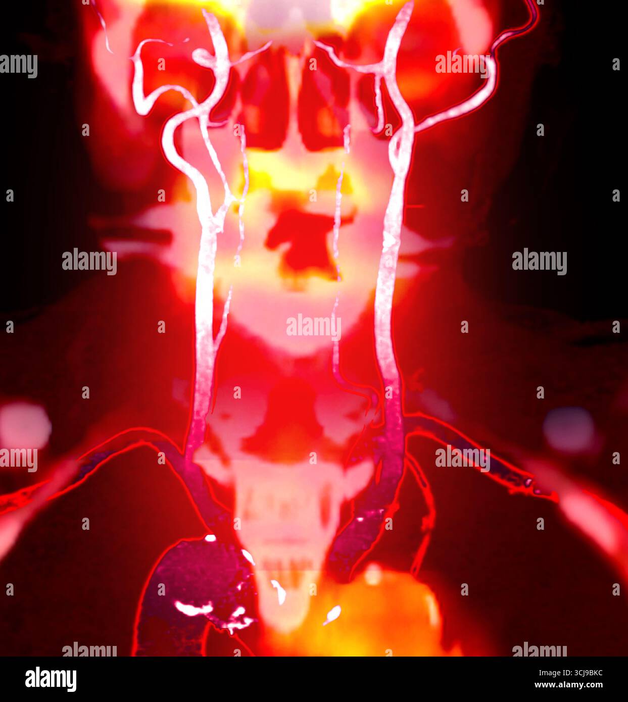 Vivid MRA scan reveals symmetrical flow of blood through the neck's ...
