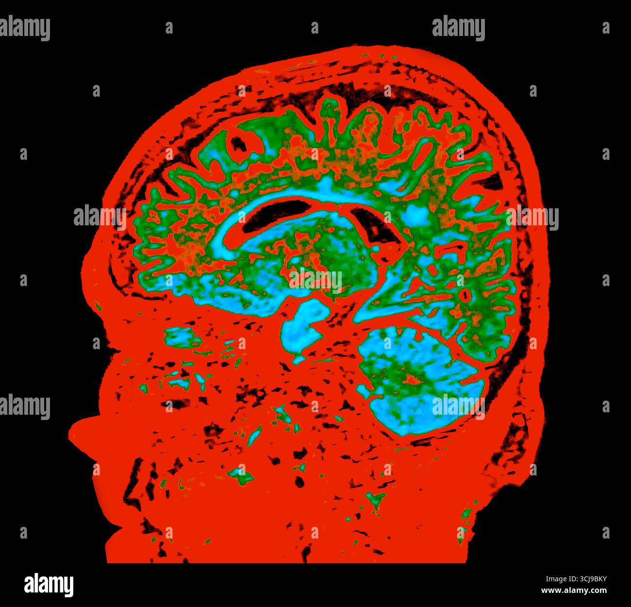 The color-enhanced MRI reveals the brain’s anatomy in striking hues. It ...