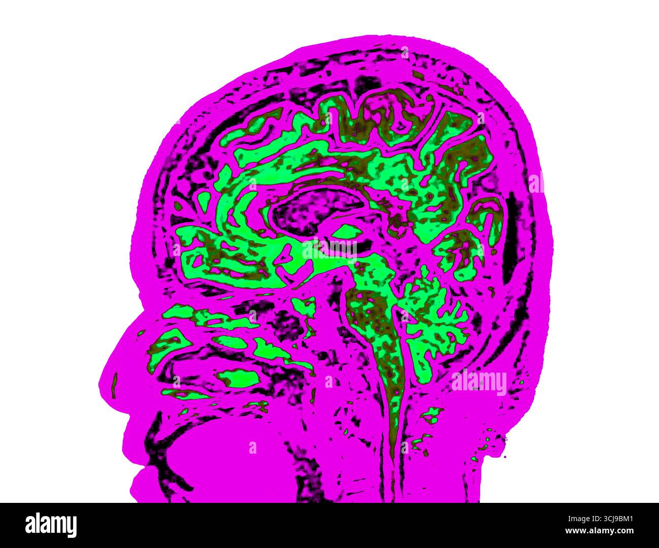 The color-enhanced MRI reveals the brain’s anatomy in striking hues. It ...