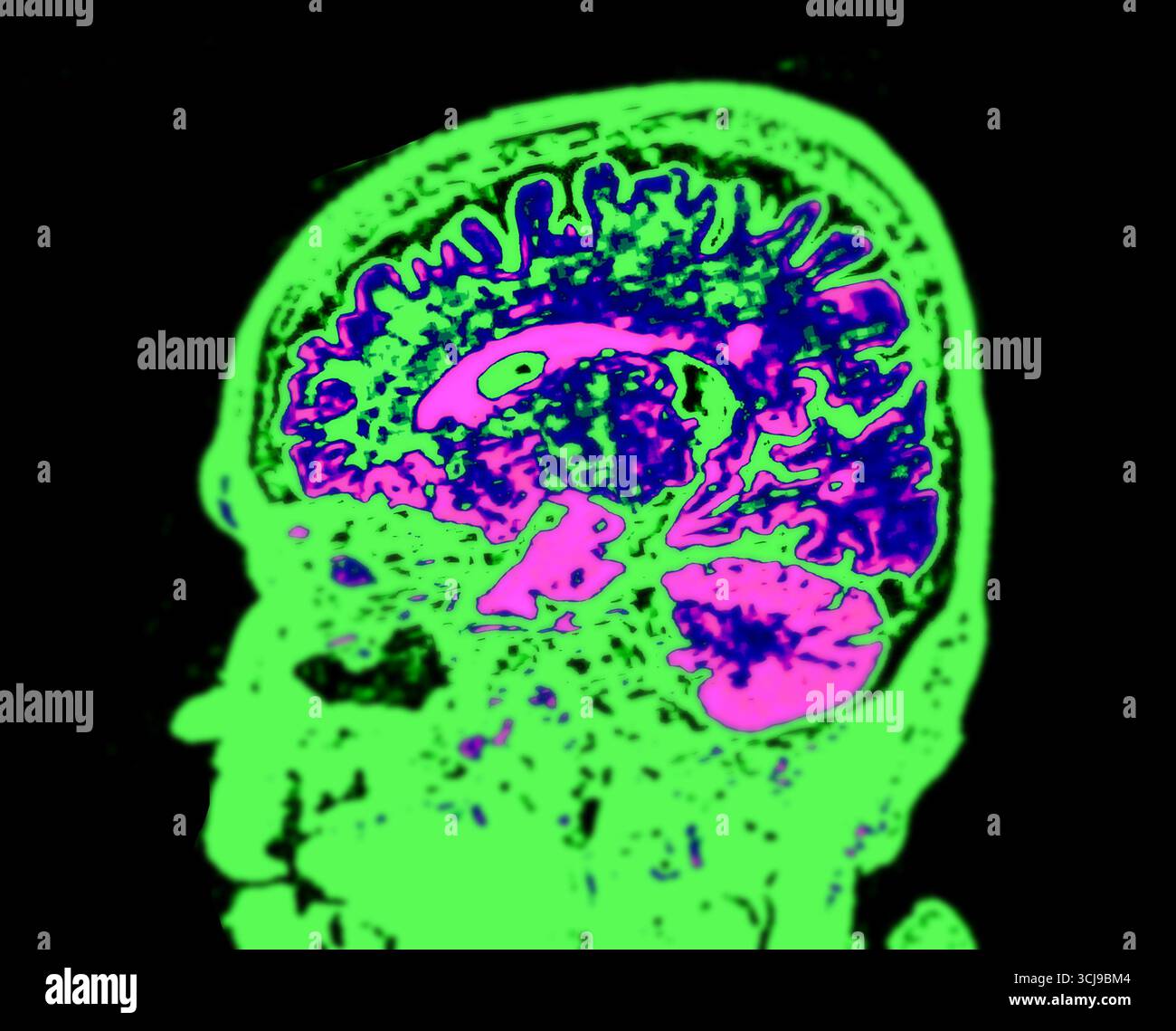 The color-enhanced MRI reveals the brain’s anatomy in striking hues. It ...