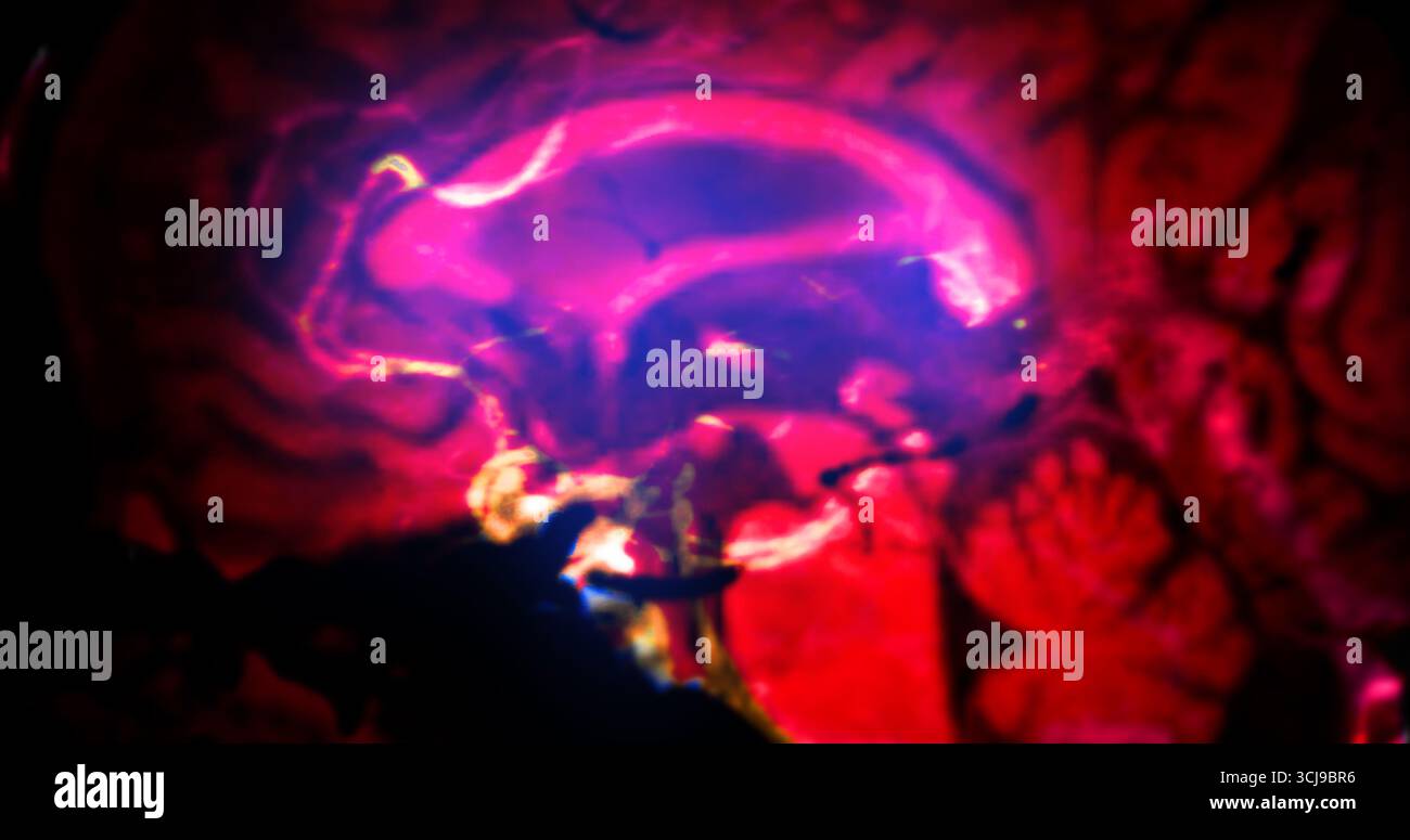 A vivid cerebral angiogram reveals the intricate network of brain ...